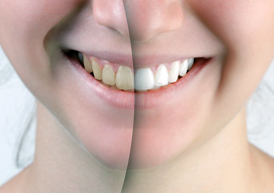 6 Ways to Naturally Whiten Your Teeth - Well.Org